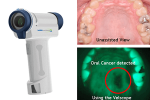 Oral ID Cancer Screening | Life Dental Group